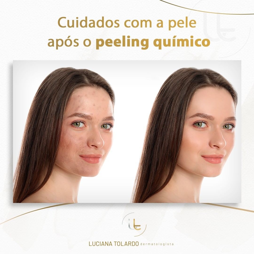 Cuidados com a pele após o peeling químico - Dra Luciana Tolardo
